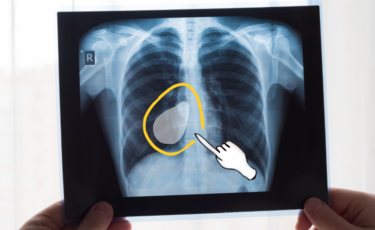 嚢胞性肺疾患（のうほうせいはいしっかん）とはどんな病気？ - 東京御嶽山呼吸器内科・内科クリニック